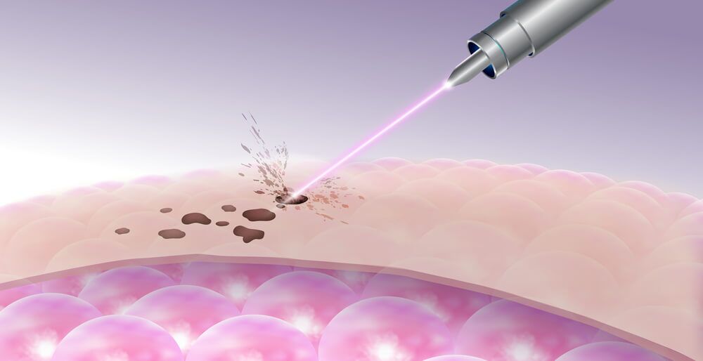 Laser Skin Treatment Ryde, Sydney | Top Beauty Laser Clinic